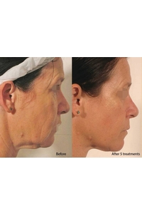 A little insight into the only Lipofirm Pro Trilipo treatments in ...